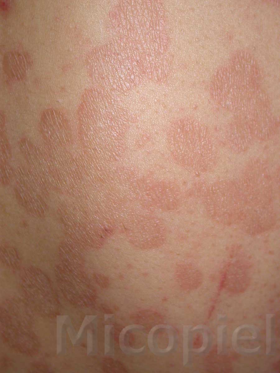 Caso clínico Nº 46. Pitiriasis Versicolor – PIEL-L Latinoamericana