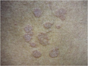 Caso clínico Nº 46. Pitiriasis Versicolor – PIEL-L Latinoamericana