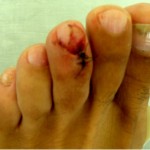 Fibroma Digital Adquirido (Apropósito de un caso) – PIEL-L Latinoamericana