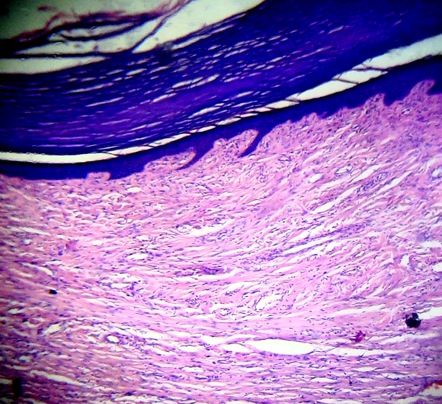 Fibroma Digital Adquirido (Apropósito de un caso) – PIEL-L Latinoamericana