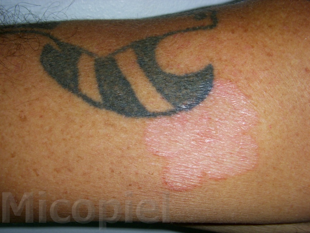 Dermatomicosis; Dermatopatías por Hongos