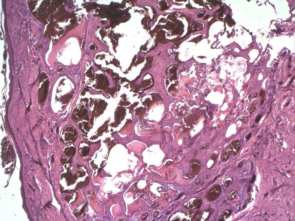 Evolución caso presentado en edición 247: Aparición de neoformación ...