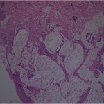 CASO N 9. Tumoracion de tejido nervioso para diagnóstico y conducta ...