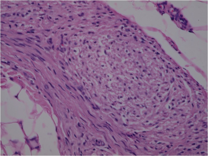 CASO N 9. Tumoracion de tejido nervioso para diagnóstico y conducta ...