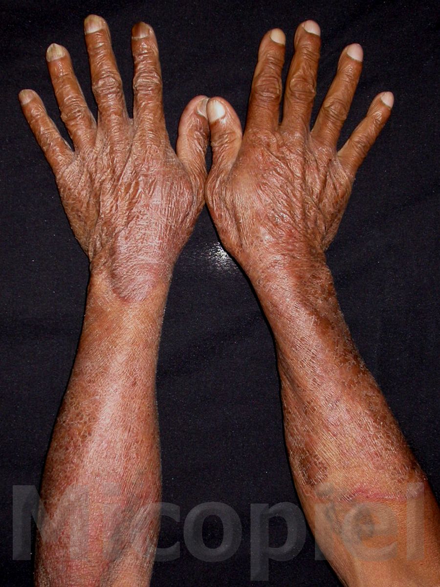 Caso clínico Nº 48. Dermatomicosis – PIEL-L Latinoamericana