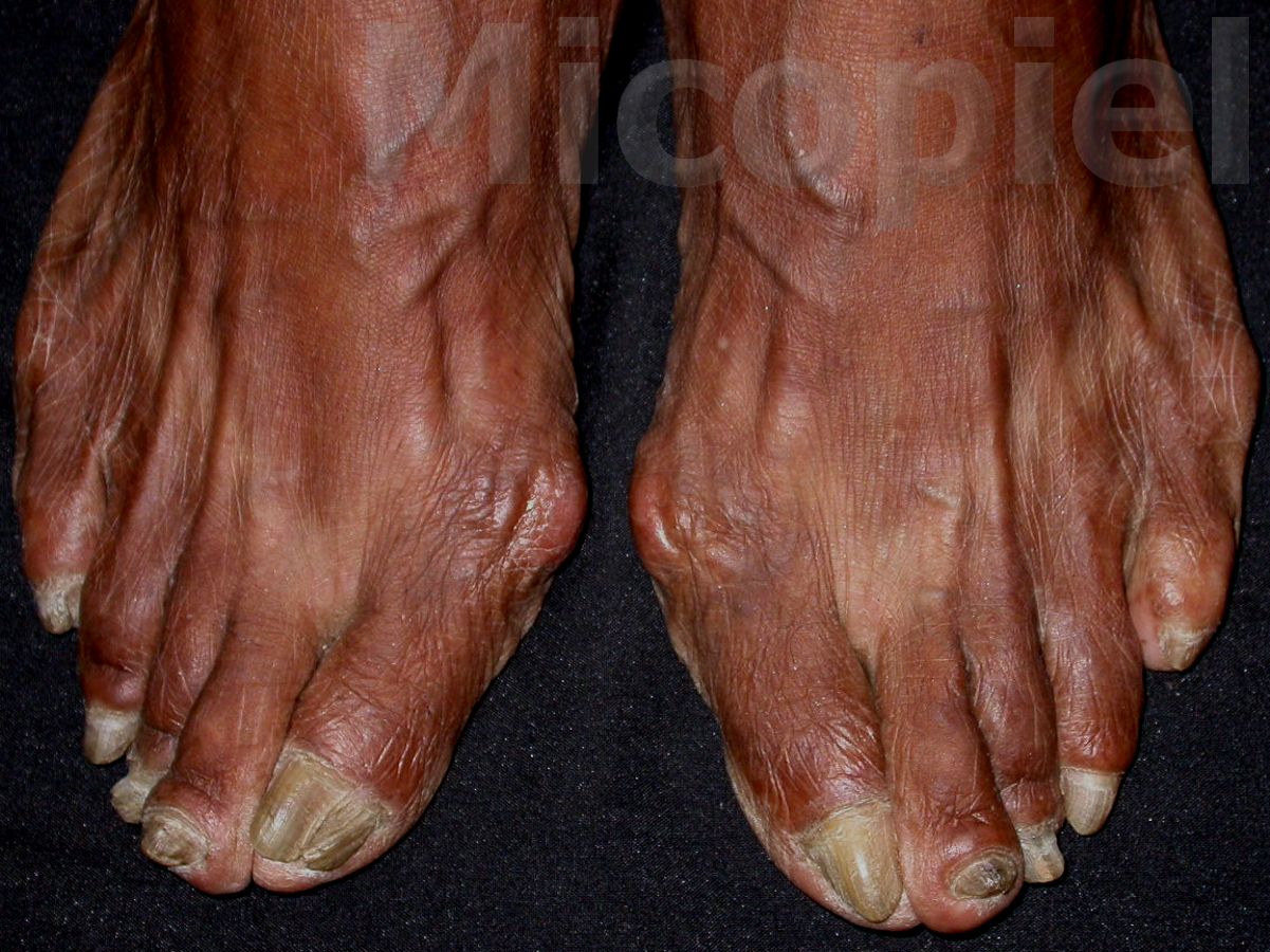 Caso clínico Nº 48. Dermatomicosis – PIEL-L Latinoamericana