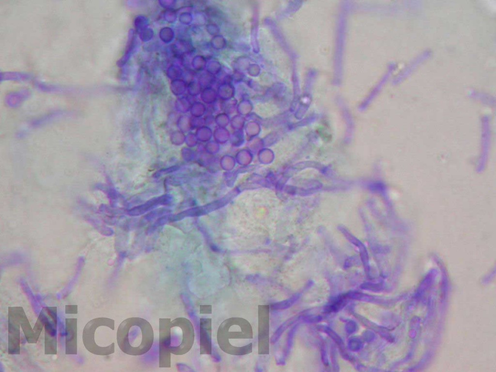 Caso clínico Nº 48. Dermatomicosis – PIEL-L Latinoamericana