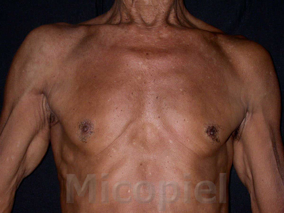 Caso clínico Nº 48. Dermatomicosis – PIEL-L Latinoamericana