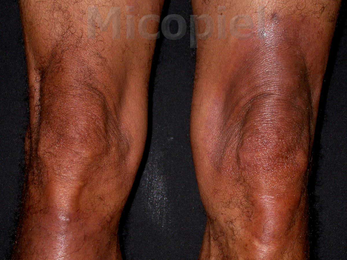 Caso clínico Nº 48. Dermatomicosis – PIEL-L Latinoamericana