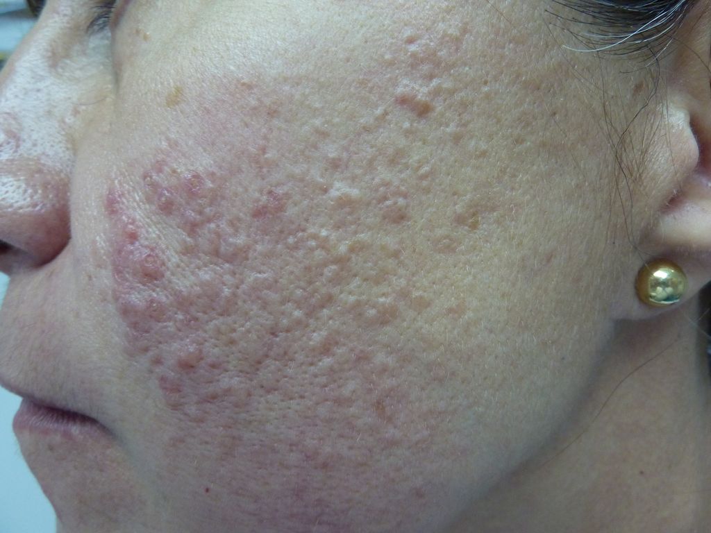 Consulta a un Colega Nº3 Edición 277: Pápulas bien delimitadas desde ...