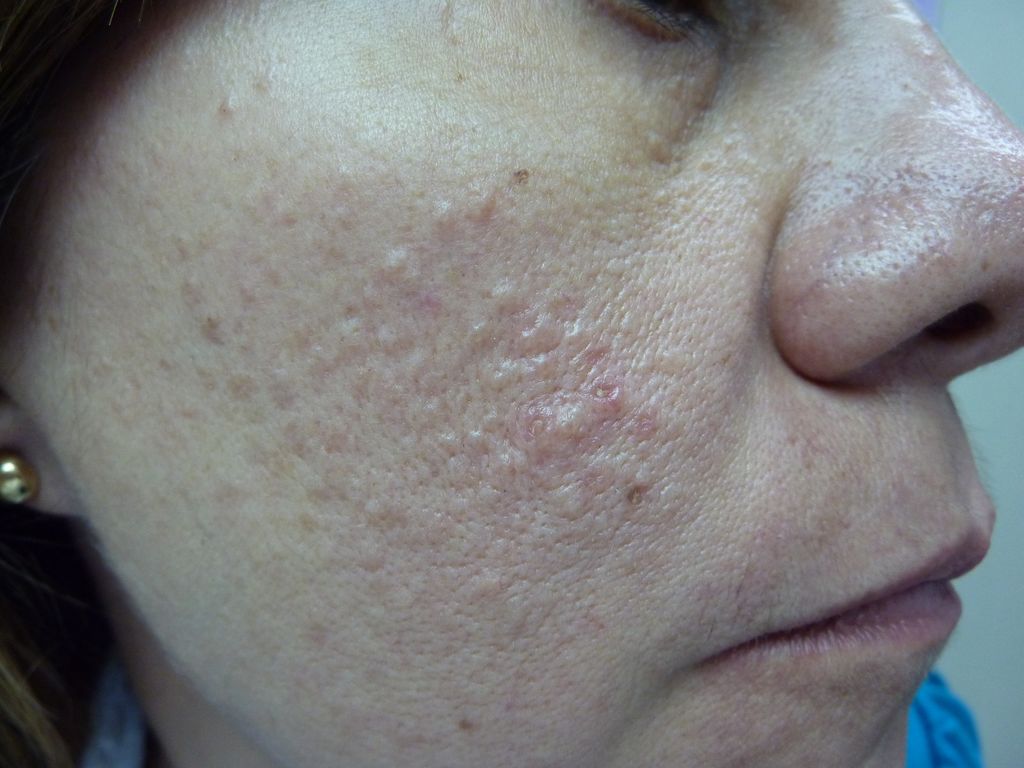 Consulta a un Colega Nº3 Edición 277: Pápulas bien delimitadas desde ...