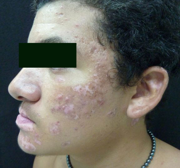 Consulta a un Colega Nº1 Edición 277: Múltiples placas infiltradas ...