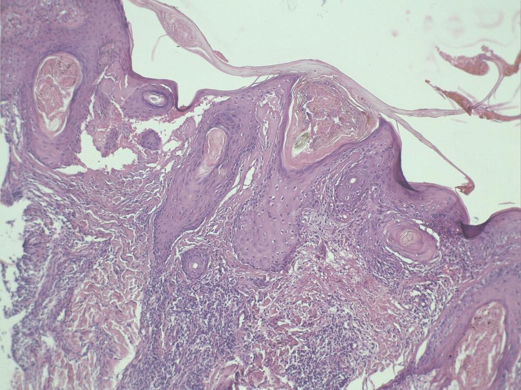 Consulta a un Colega Nº1 Edición 277: Múltiples placas infiltradas ...