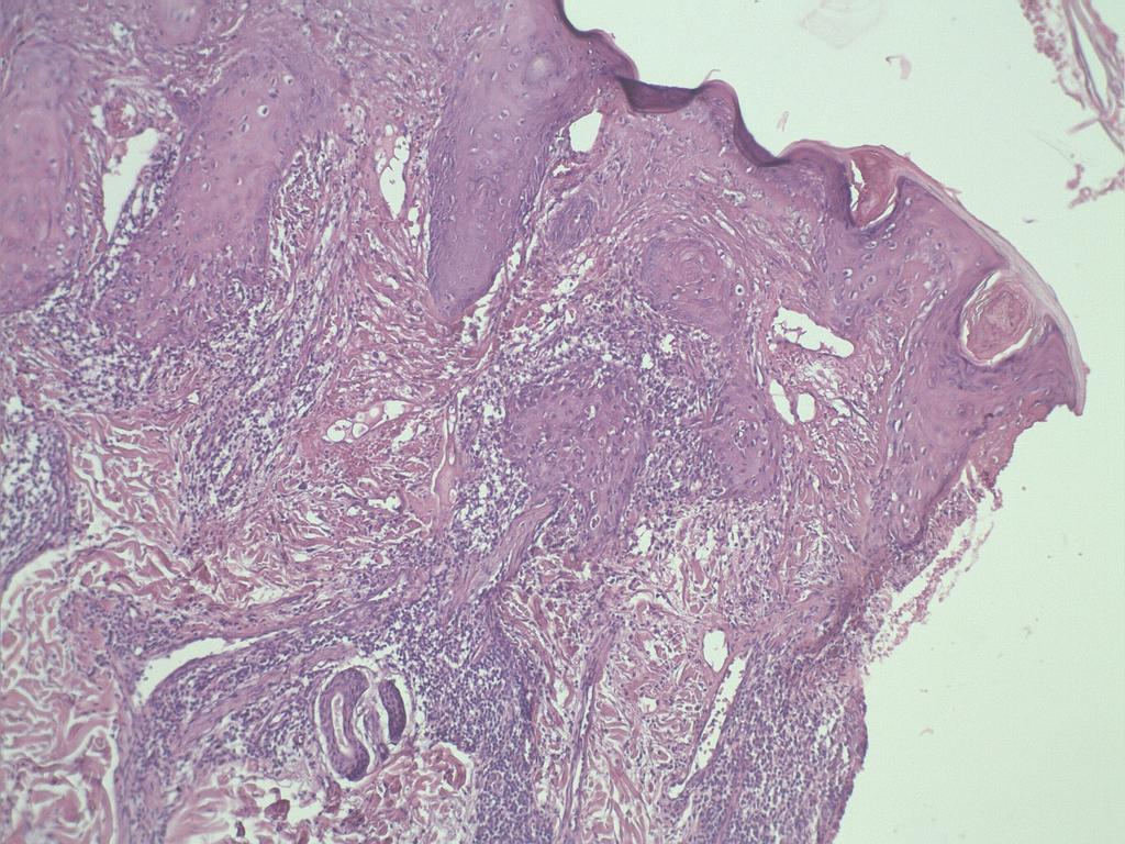 Consulta a un Colega Nº1 Edición 277: Múltiples placas infiltradas ...