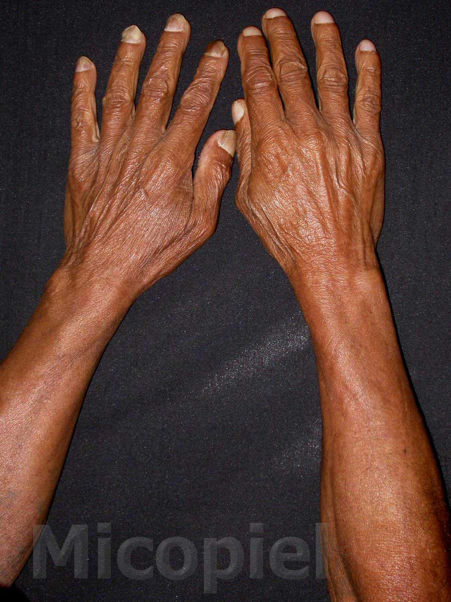 Caso clínico Nº 48. Dermatomicosis – PIEL-L Latinoamericana