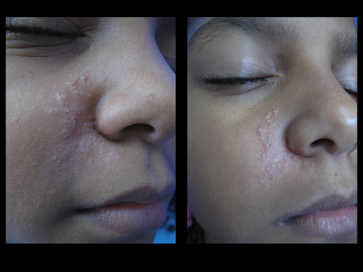 Consulta a un Colega Nº 3 Edición 276: Pápulas eritematosas en cara ...