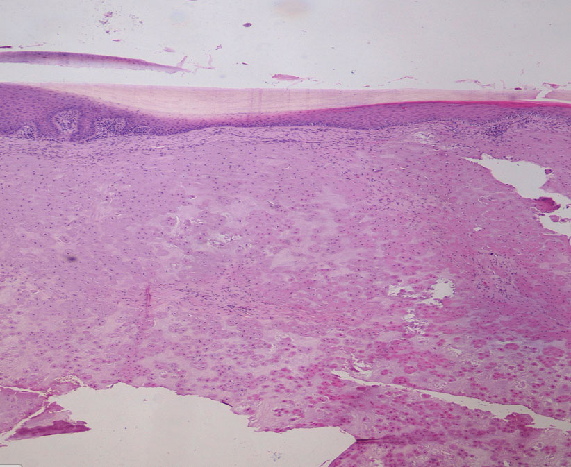 A la manera de Close-up: Tumoración en pulpejo dedo medio – PIEL-L ...