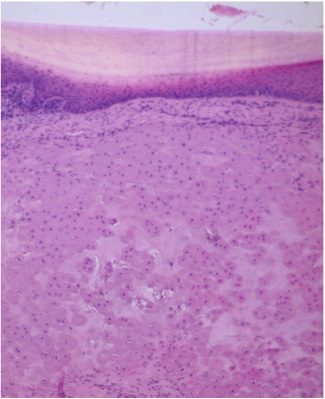 A la manera de Close-up: Tumoración en pulpejo dedo medio – PIEL-L ...