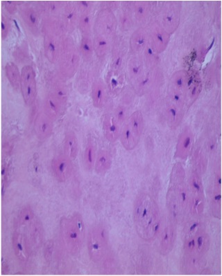 A la manera de Close-up: Tumoración en pulpejo dedo medio – PIEL-L ...
