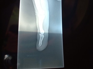 A la manera de Close-up: Tumoración en pulpejo dedo medio – PIEL-L ...