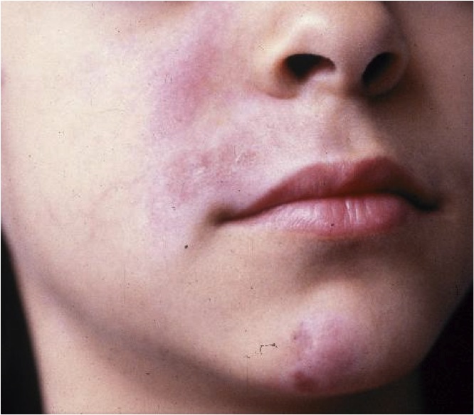 Placa infiltrada parcialmente descamativa y atrófica – PIEL-L ...