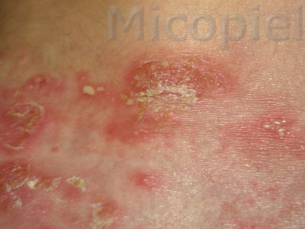 Caso clínico Nº 49. Dermatosis Familiar. – PIEL-L Latinoamericana