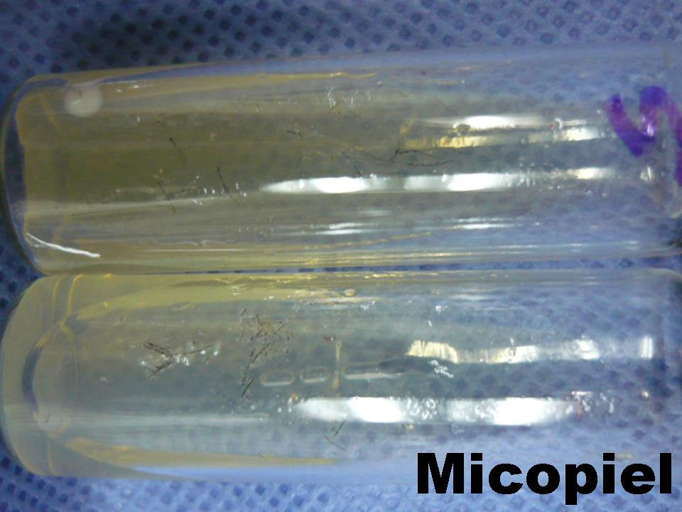 Caso clínico Nº 50. Alopecia Difusa – PIEL-L Latinoamericana
