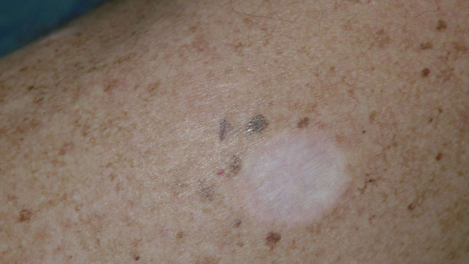 Dermatoscopia Edición 283: Reto diagnóstico – PIEL-L Latinoamericana