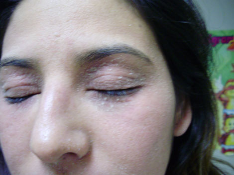 A propósito de un caso de Dermatitis Alérgica de Contacto Facial a ...
