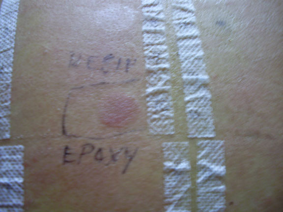 A propósito de un caso de Dermatitis Alérgica de Contacto Facial a ...