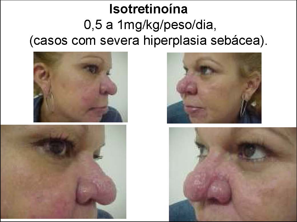 CAPITULO 106: Rosácea e Rinofima: Condutas terapéuticas, clinicas e ...