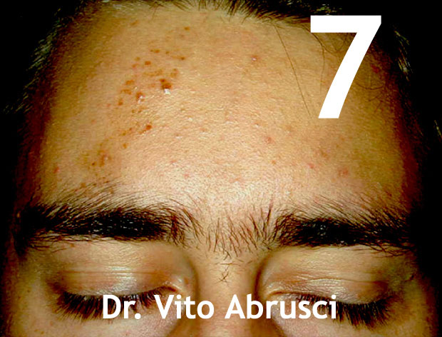 N° 5 Tratamiento Quirurgico de los Nevus: Respuesta 2a Parte – PIEL-L ...