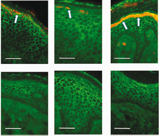 Rol de los antagonistas TNF-alfa para mejorar la barrera cutánea – PIEL ...