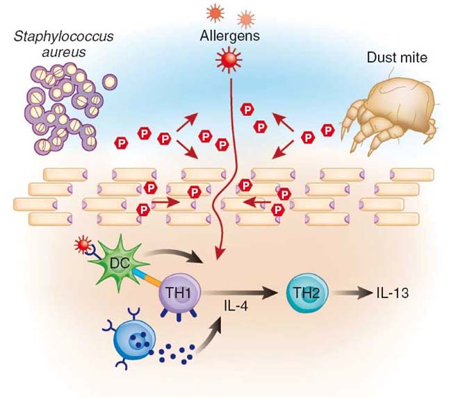 De todo un poco en la Dermatitis Atópica – PIEL-L Latinoamericana