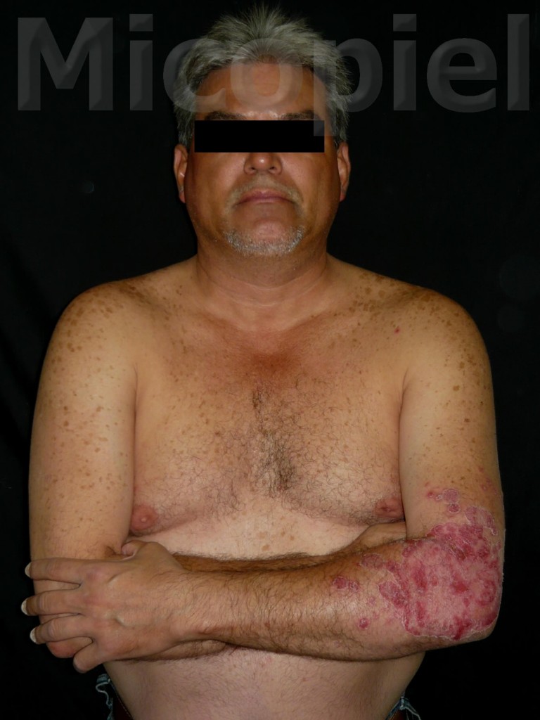 Caso clínico Nº 53. Placa eritematodescamativa en miembro superior I ...