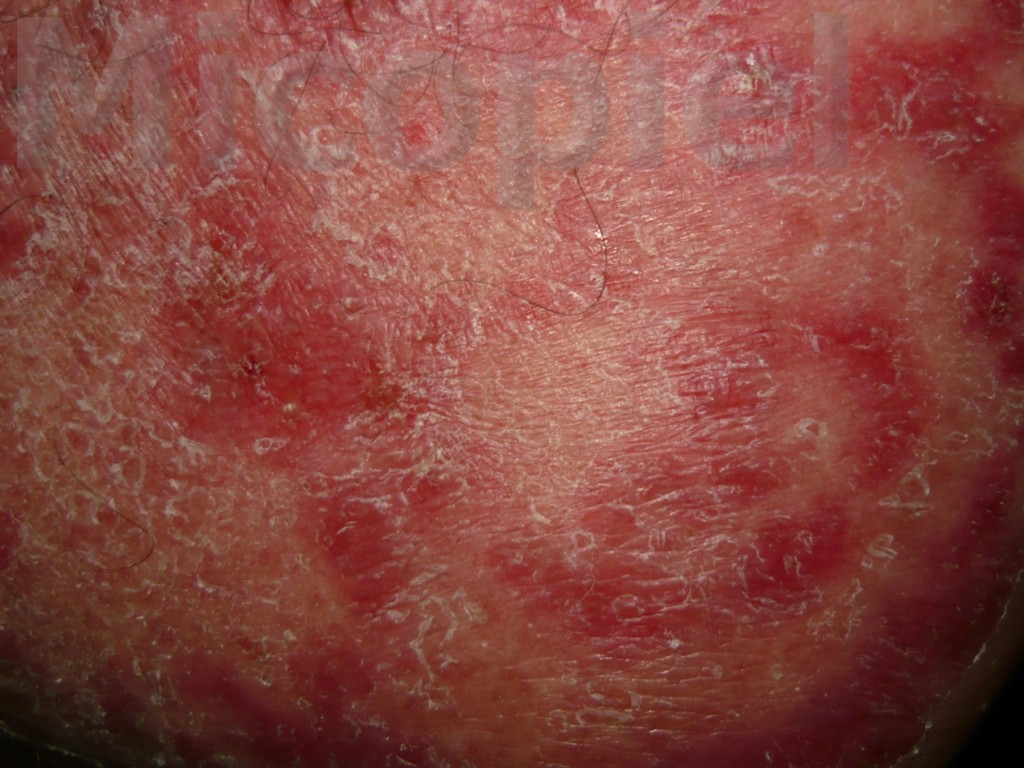 Caso clínico Nº 53. Placa eritematodescamativa en miembro superior I ...
