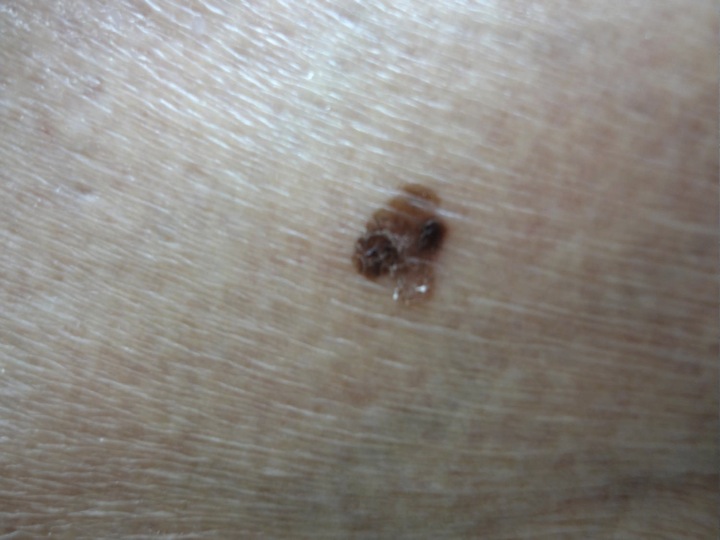 Correlación clínico-patológica-dermatoscópica – PIEL-L Latinoamericana