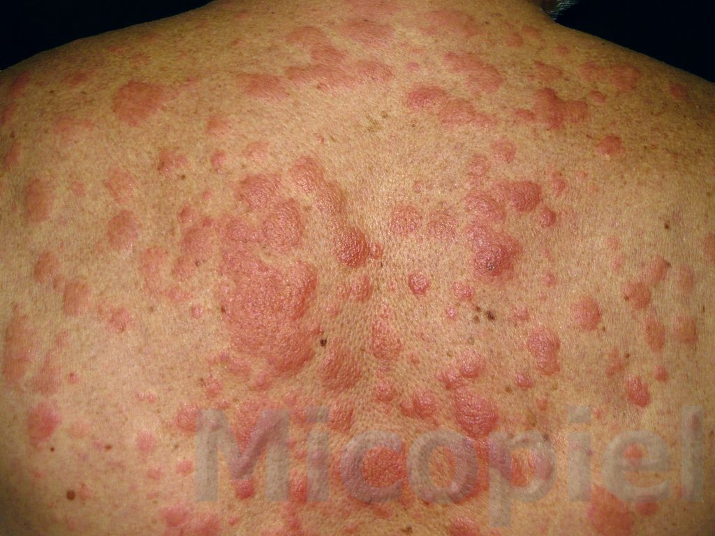 Lepra Dimorfa; Lepra Incierta