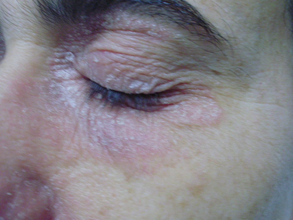 Cambio En segundo lugar tubo dermatitis seborreica parpados Abultar ...