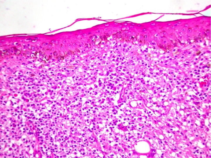 Leishmaniasis Cutánea – PIEL-L Latinoamericana