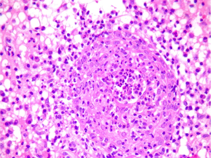 Leishmaniasis Cutánea – PIEL-L Latinoamericana