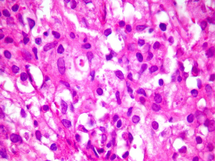 Leishmaniasis Cutánea – PIEL-L Latinoamericana