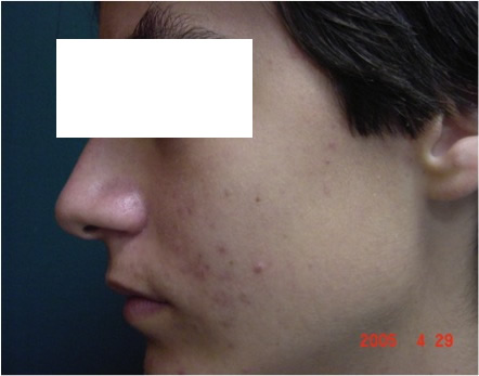 Atlas de dermatología: Acné – PIEL-L Latinoamericana