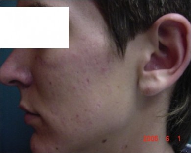 Atlas de dermatología: Acné – PIEL-L Latinoamericana