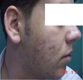 Atlas de dermatología: Acné – PIEL-L Latinoamericana