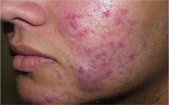 Atlas de dermatología: Acné – PIEL-L Latinoamericana