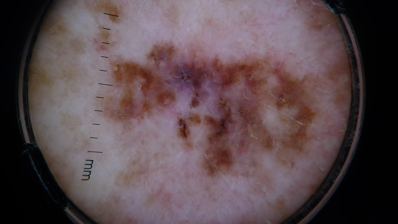 Dermatoscopia en el consultorio Ed.307 – PIEL-L Latinoamericana