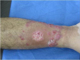 Leishmaniasis cutánea intermedia. Reto terapéutico – PIEL-L Latinoamericana