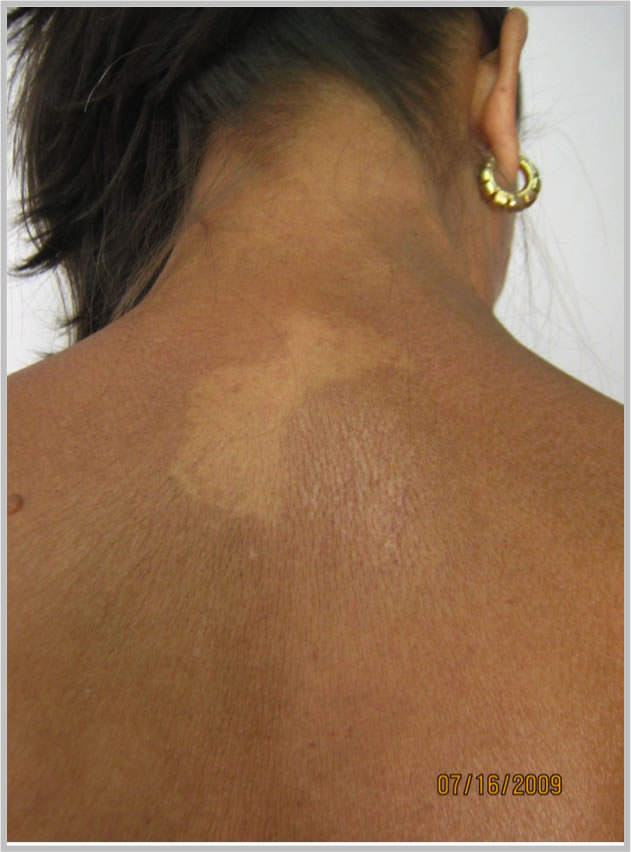 Caso Nº1 Ed.307: Mujer de 62 años con placas de Morfea muy extensas con ...