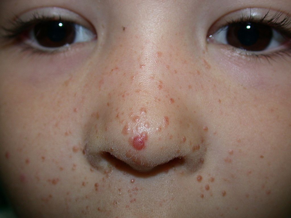 Cosmética: Múltiples pápulas en regional nasal y peribucal – PIEL-L ...